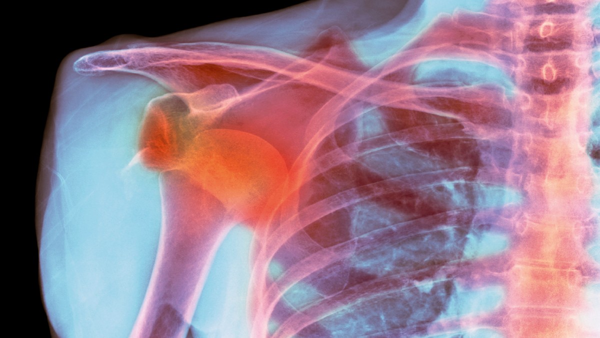 Self-management of shoulder dislocation could save the NHS time | The ...